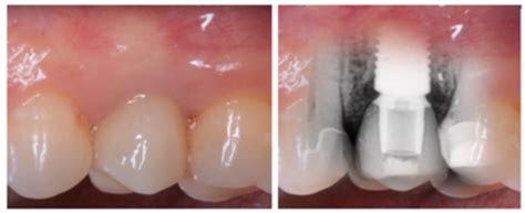 Soft Tissue Implant Integration Part 1