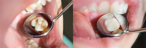 How Do Fillings Work