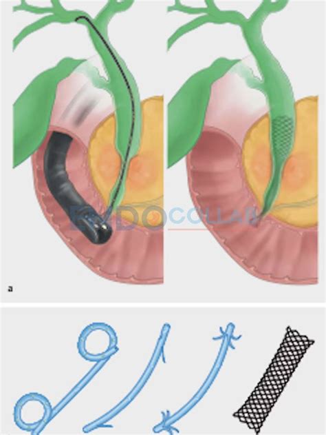 Ercp Series Stents For Pancreatobiliary Strictures Endocollab™ Gi Endoscopy Education