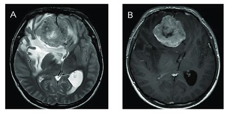 Axial T2 A And T1 Weighted Post Contrast B Magnetic Resonance