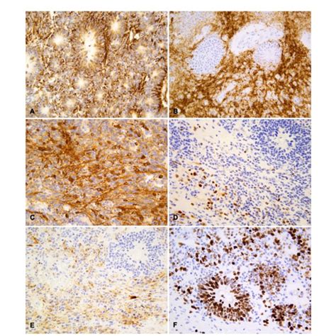 Figure E Feline Embryonal Tumor With Multilayered Rosettes