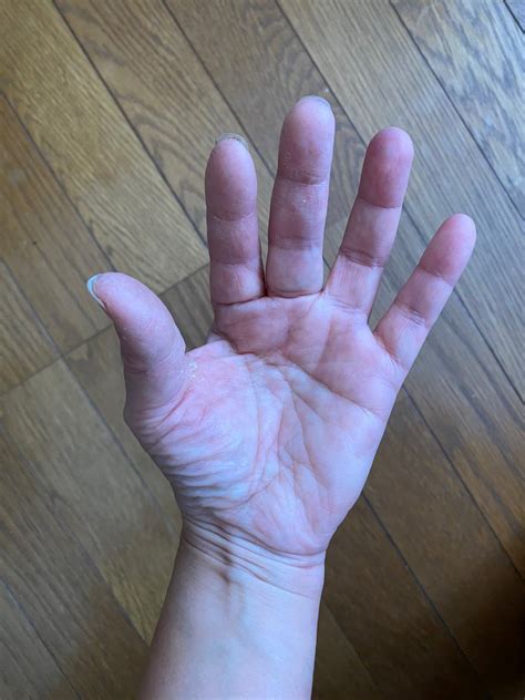 こんなに回復しました 幸せです 脱ステロイド中指の皮がむける 刺激性接触性皮膚炎