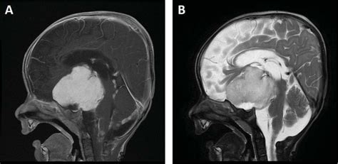 Magnetic Resonance Imaging Mri Images Showing The Tumour In The