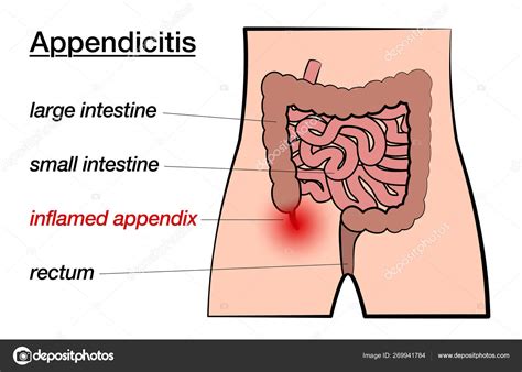 Appendicitis Inflamed Appendix Labeled Chart Stock Vector Image By