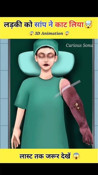 लड़की को सांप ने काट लिया🤯🐍। Snake Bite 3d Animation Treatment। Shorts