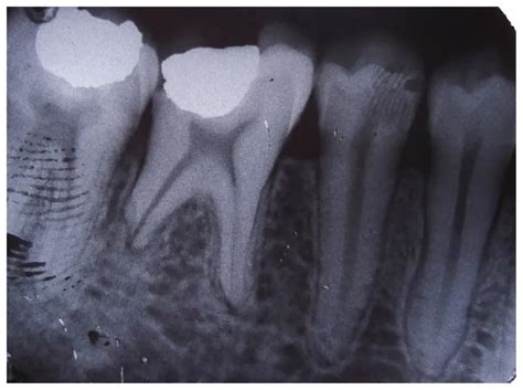 External Resorption Of Tooth