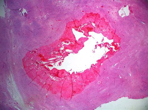 Cavernous Hemangiomas