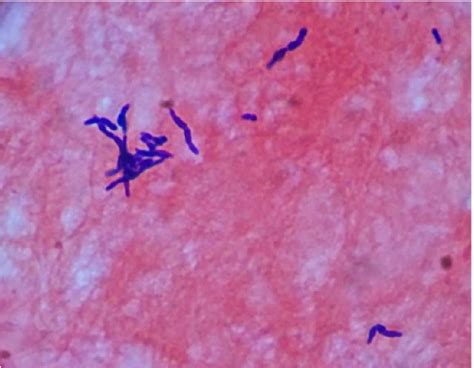 Gram Staining Of A Sputum Sample Aspirated From The Endotracheal Tube Download Scientific