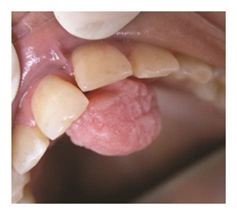 Peripheral Exophytic Oral Lesions A Clinical Decision Tree Mortazavi