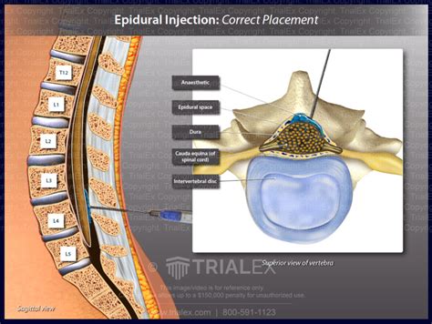 Function Of Epidural Injection At Terry Camacho Blog