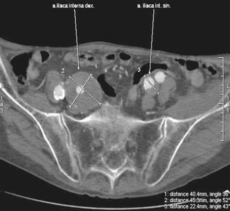 A Rare Case Of Multiple Aneurysms In Ilio Femoro Popliteal Segment With