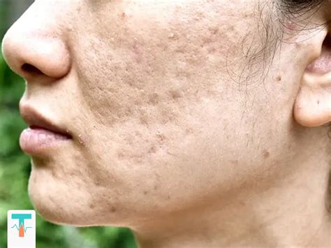 انواع جای جوش صورت؛ آتروفیک و هایپرتروفیک انواع جای جوش صورت با عکس
