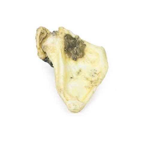 Chondrosarcoma Of Scapula 3d Anatomy Series Erler Zimmer