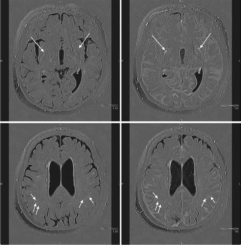 Figure 1 From The Glymphatic System A Review Of The Challenges In Visualizing Its Structure And