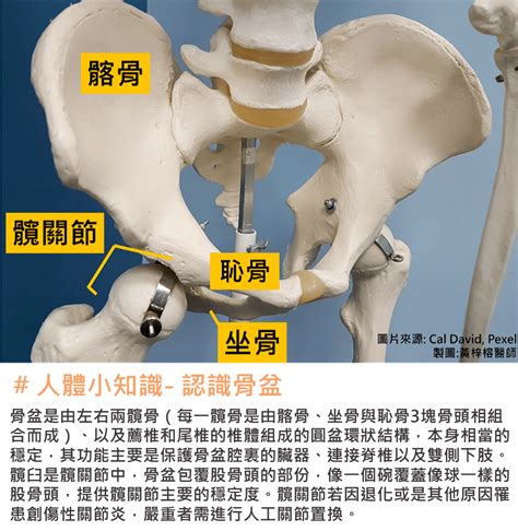 五旬婦車禍骨盆骨折 微創手術助行動恢復 長安骨科