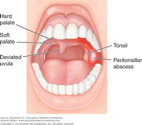 Peritonsillar Abscess Incision And Drainage Cpt Code Best Drain
