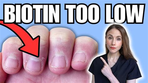 How Do You Treat Biotin Deficiency