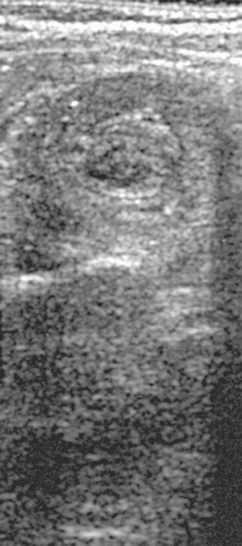 Ileus Adhesions Intussusception And Closed Loop Obstructions Clinical Tree Ileus Adhesions Intussusception And Closed Loop Obstructions Clinical Tree