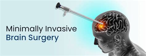 Minimally Invasive Brain Surgery In Delhi Ncr Minimally Invasive