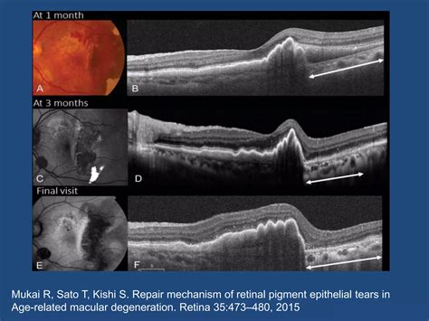 Rpe Tearretinal Pigment Epithelium Tearpptx