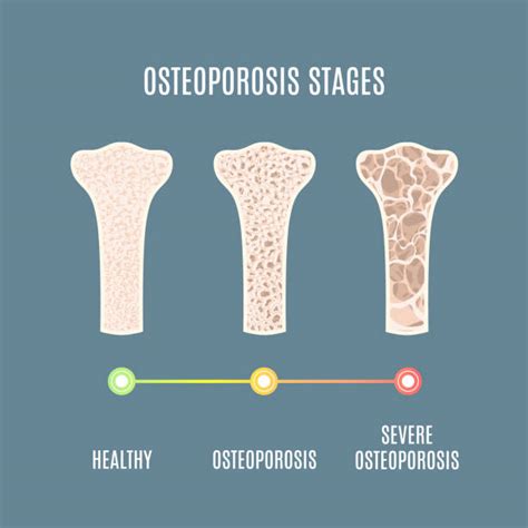 9200 Osteoporosis Stock Illustrations Royalty Free Vector Graphics