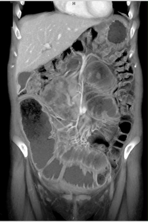 Dilated Small Bowel Due To Enteritis Small Bowel Radiology Case