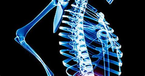 Finally Got The Results Of My Mri Back And I Have Several Herniated