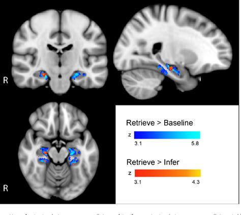 Figure 1 From A Specific Role Of The Human Hippocampus In Recall Of Temporal Sequences