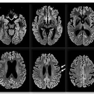 Brain Magnetic Resonance Imaging MRI Diffusion Weighted Imaging