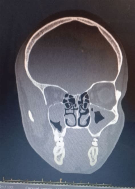 Awaiting Endoscopic Sinus Surgery R Sinusitis