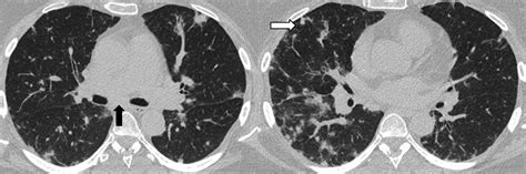 Granulomatous Lymphocytic Interstitial Lung Disease Description Of A