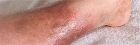 What Is Cellulitis Natures Best