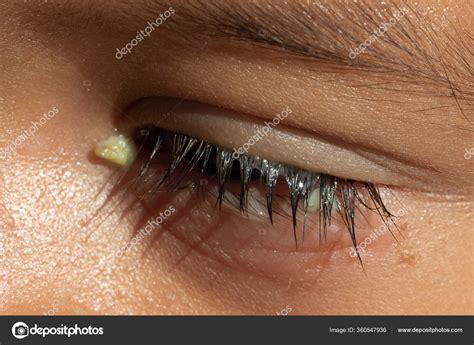 Allergic Conjunctivitis Discharge