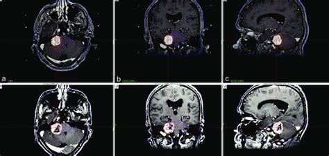 Axial Coronal And Sagittal T1 Contrast Views Of A Patient With A