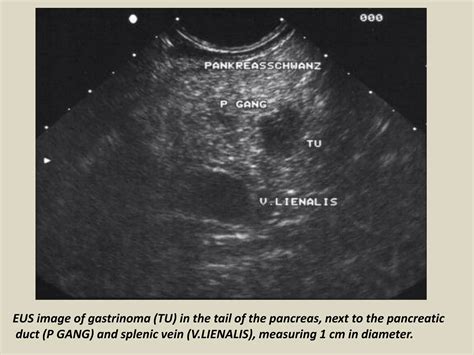 Ultrasound Of Pancrease In Radiology Pptx Ultrasound Of Pancrease In Radiology Pptx