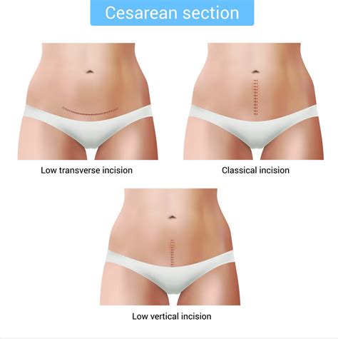 Incision After C Section