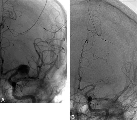 Figure 1 From Of 5 Cases Of The Pipeline Embolization Device Report