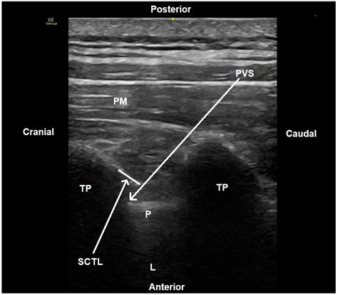 Ultrasound Guided Rhomboid Intercostal Block A Pilot