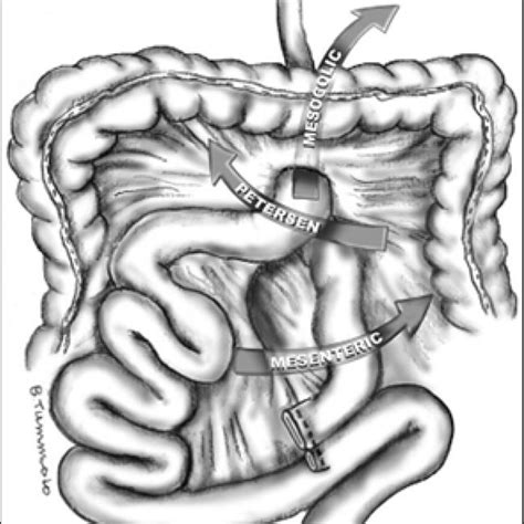 A Internal Hernia Through The Jejunal Mesenteric Defect And B The