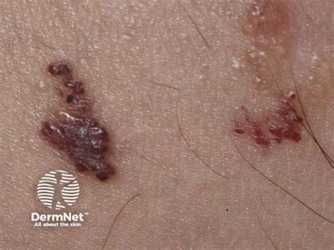 Lymphangioma Circumscriptum Scholars Journal Of Medical Case Reports