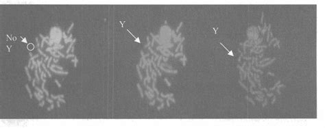 Figure 2 From Comparative Genomic Hybridization To Detect Unbalanced Chromosomal Rearrangement