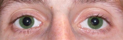 Can Aneurysm Cause One Pupil To Be More Dilated Than The Other Scary