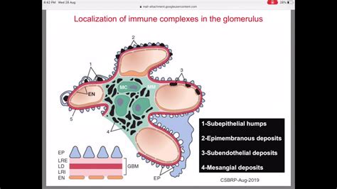 Renal Glomerular Disease Youtube