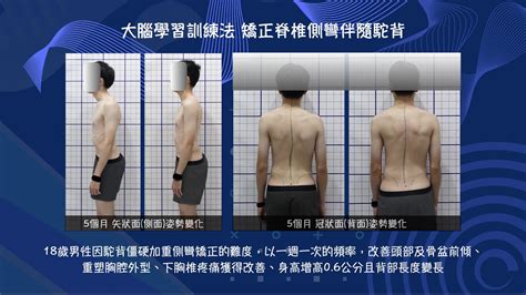 閻曉華側彎研究中心 【駝背與脊椎側彎可以同時矯正嗎？】