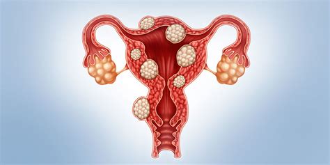 One Of The Best Tips About How To Treat Fibroid Tumors Waylake