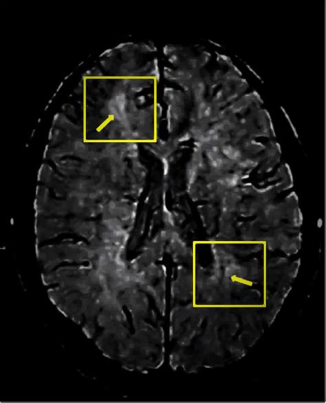 T2 Weighted Gradient Echo Mri Scan Scan Of A 19 Year Old Female
