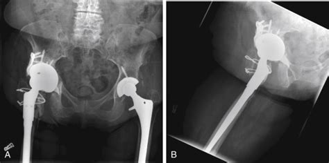 Acetabular Bone Loss Case Presentations Musculoskeletal Key