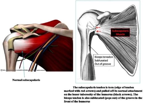 Subscapularis Tendon Tear Symptoms Treatments Shoulder Specialist In Mumbai Dr Amyn Rajani