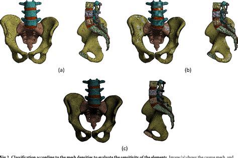 Figure 1 From Effect Of The Screw Type S2 Alar Iliac And Iliac Screw