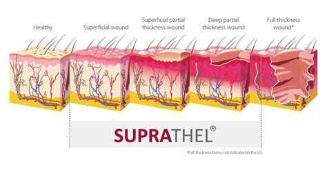 Partial Thickness Wound